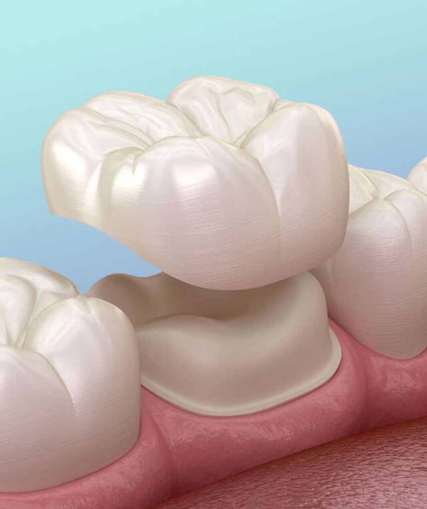 Crowns Adelaide | Same Day | Zirconium | E-Max | Tea Tree Dental