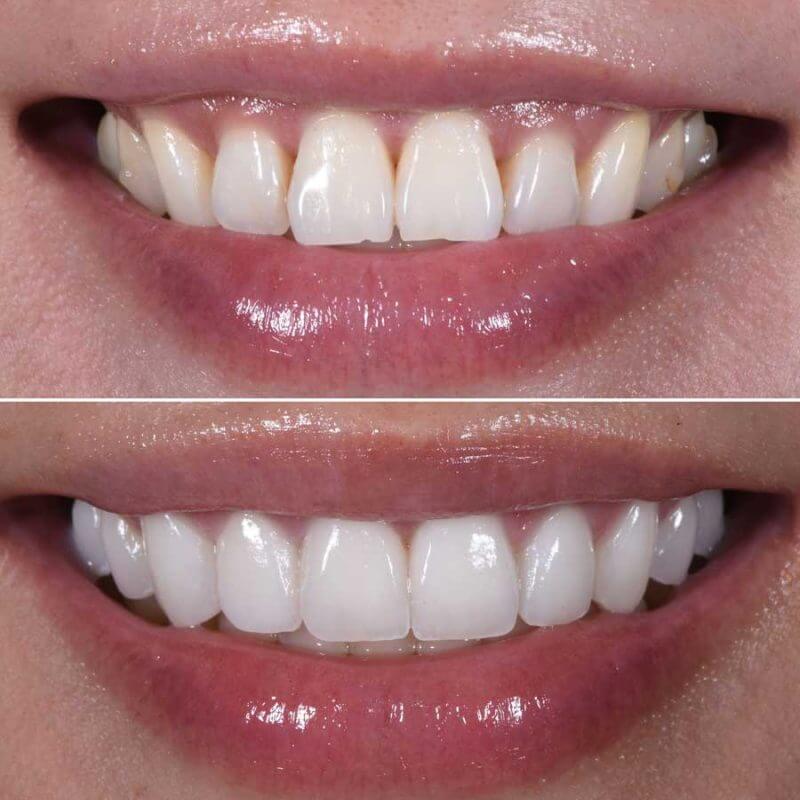 Dental Veneers Adelaide | Cosmetic Dentist Modbury | Tea Tree Dental