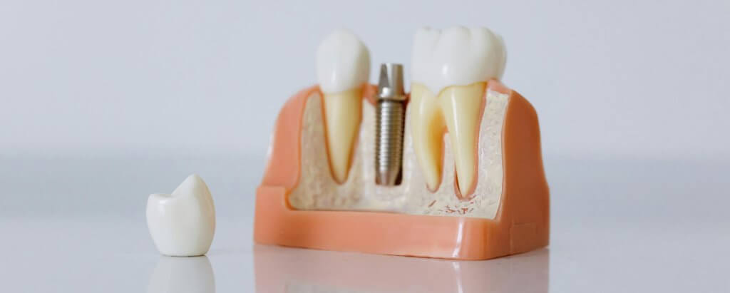 Dental Implants Modbury | Missing Teeth | Major Dental